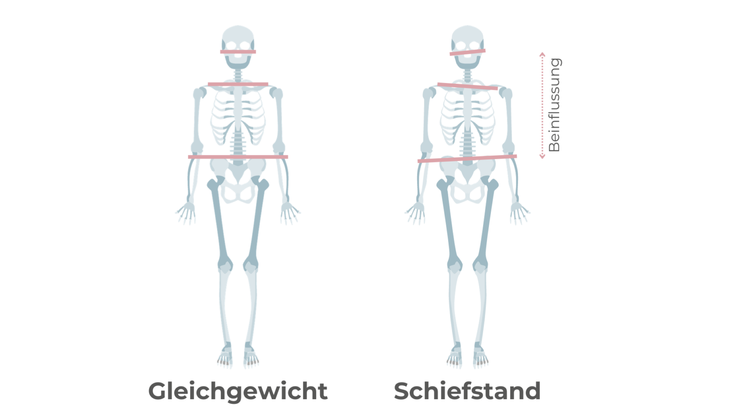Beckenschiefstand: Wenn das Fundament aus dem Gleichgewicht gerät ...